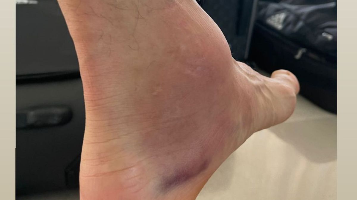 Así quedó el tobillo de Di María tras su torcedura en la final - AS ...