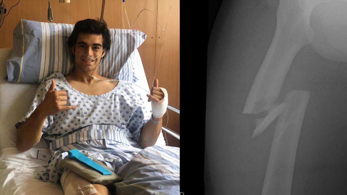 Adolf Silva se rompe el fémur tras una dura caída en el Loosefest XL ...