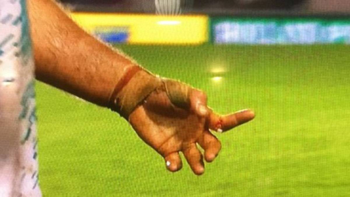 Rugby: Espeluznante lesión de dedo de un jugador de los Harlequins - AS.com